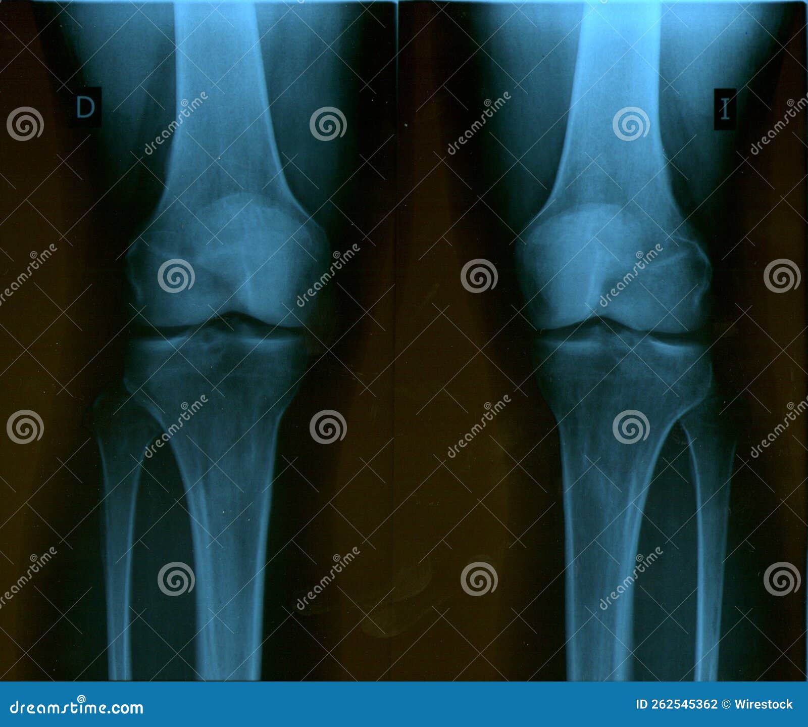 X-ray of the Leg of a Person Stock Photo - Image of health, injury ...