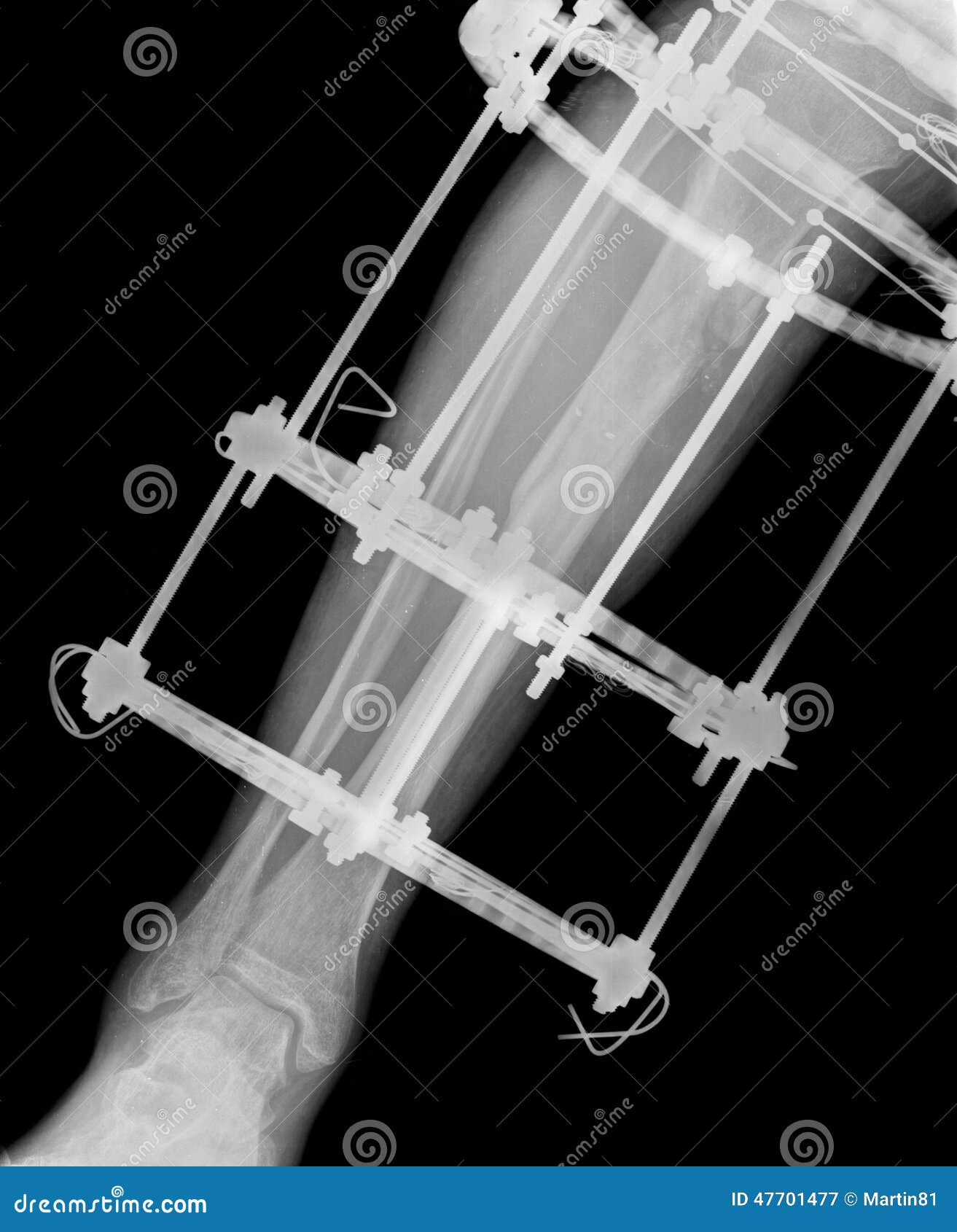 X-ray of leg with fixation stock image. Image of fibula - 47701477
