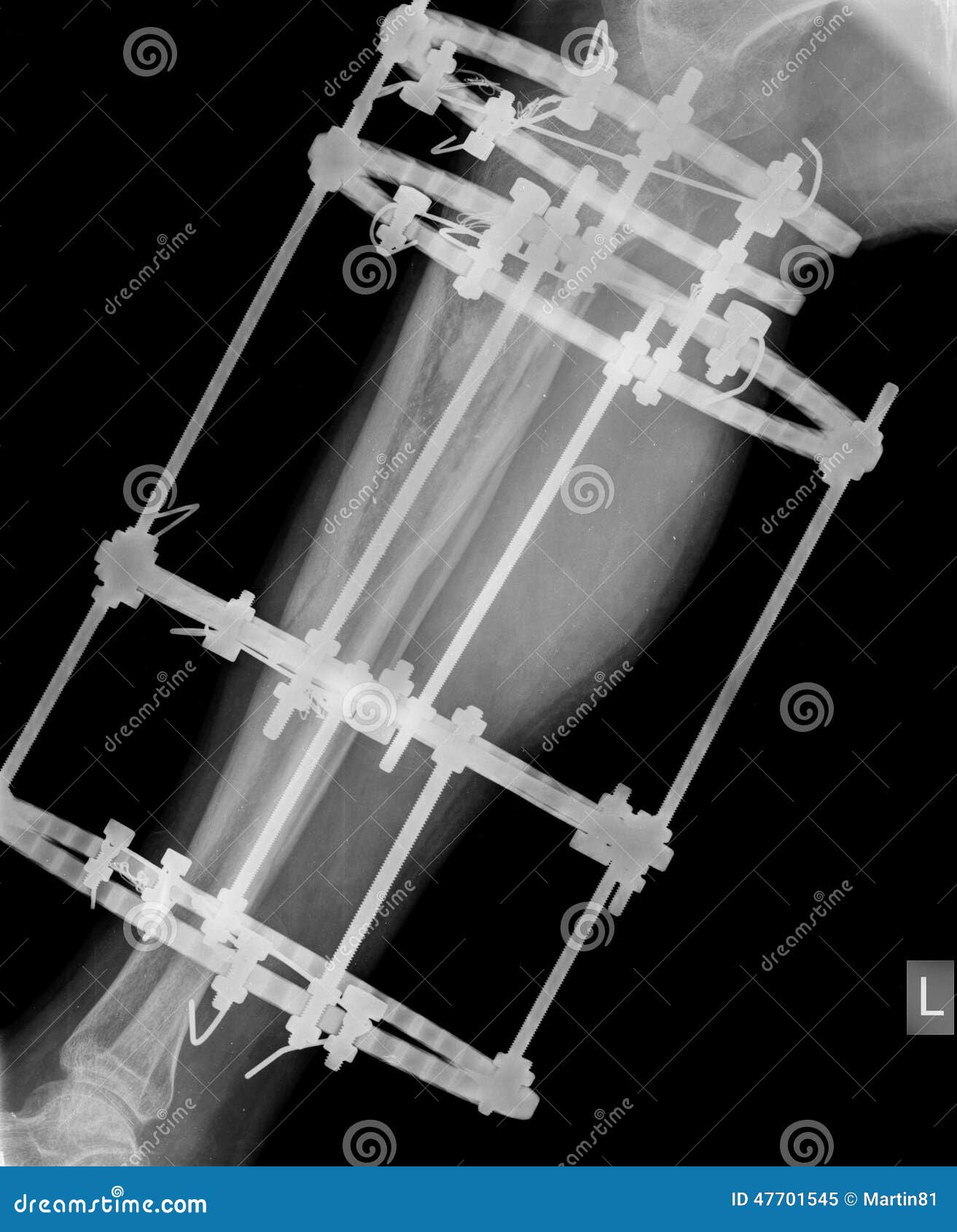 X-ray of leg with fixation stock image. Image of orthopedic - 47701545