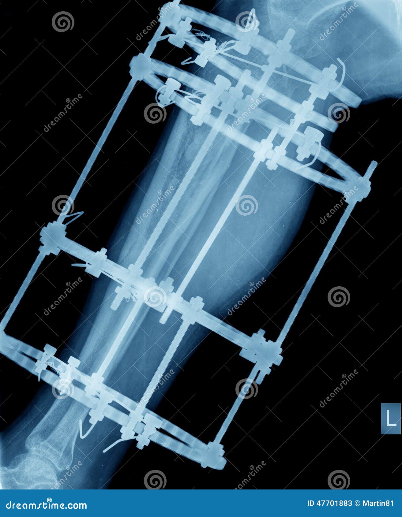 X-ray of leg with fixation stock image. Image of nurse - 47701883