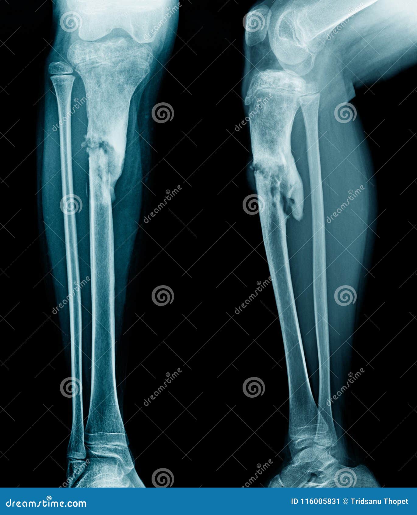 Osteomyelitis Tibia Stock Image Image Of Limb Arthritis 116005831