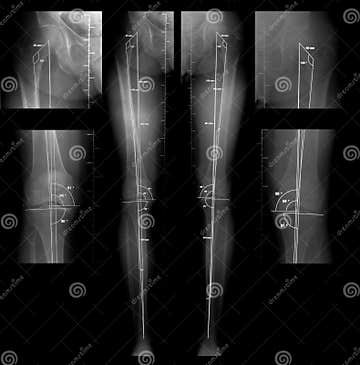 X-ray for Length Measurement on Both Legs Stock Image - Image of length ...