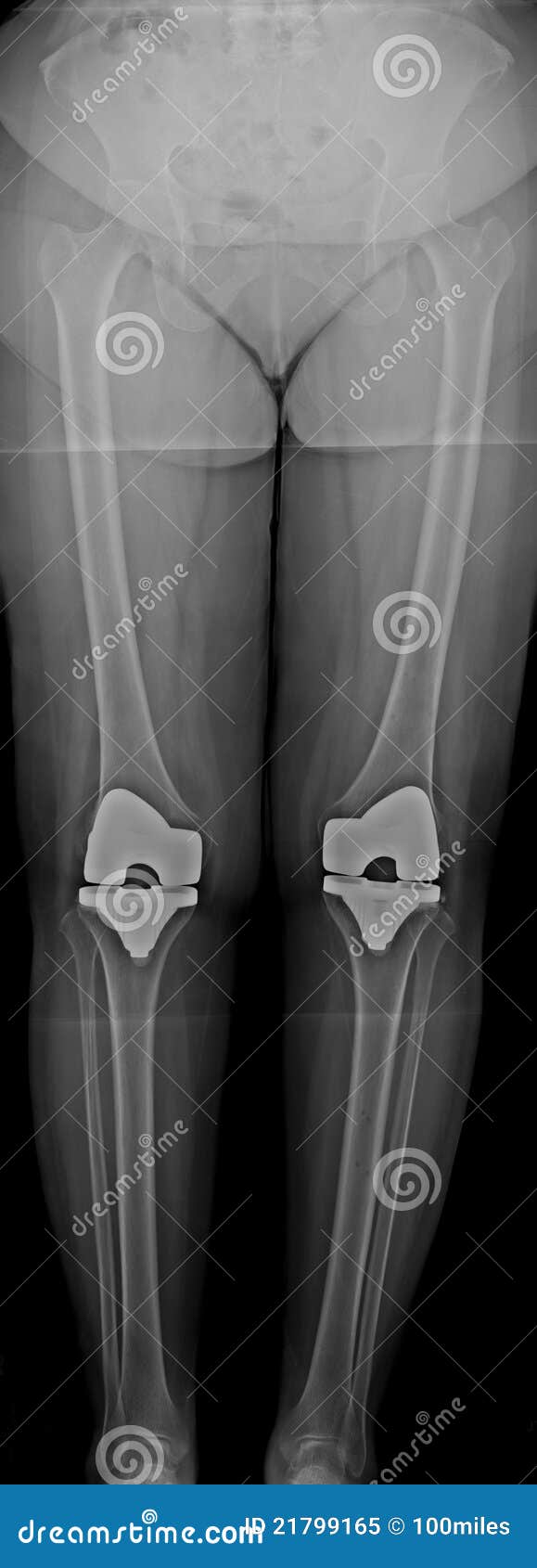 X-ray of long bones stock image. Image of clinic, femoral - 21799165