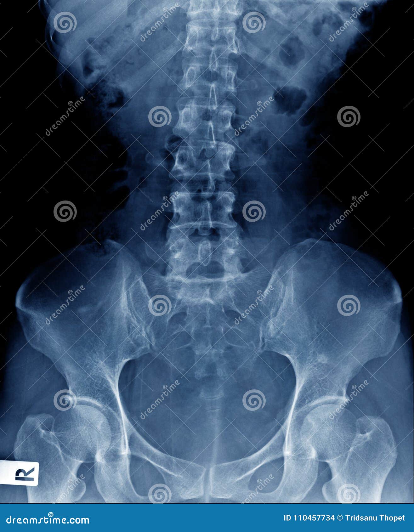 L-spine x-ray stock illustration. Illustration of hospital - 110457734