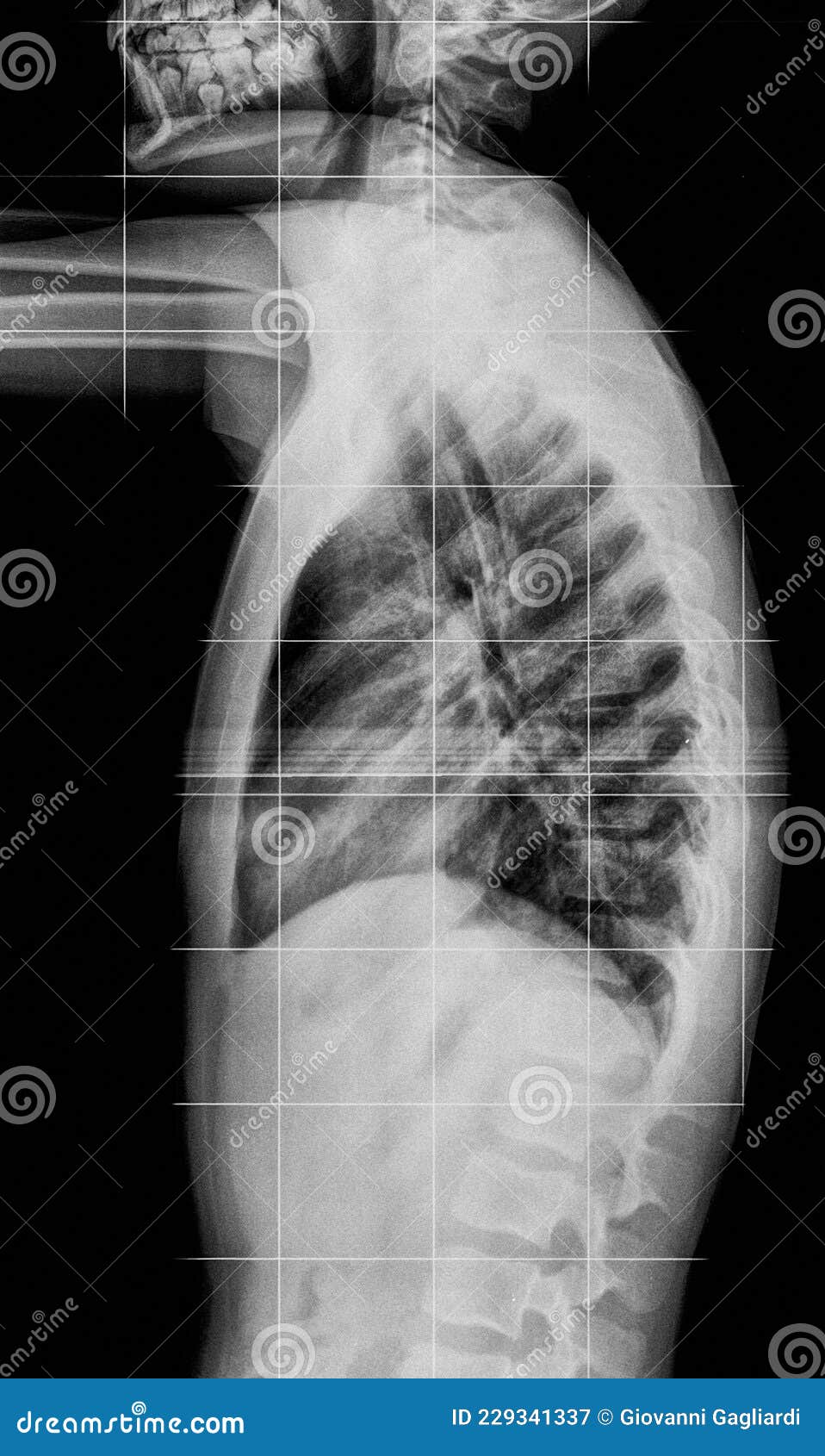 X-ray Lumbo-sacral Spine and Head Stock Image - Image of radiology ...