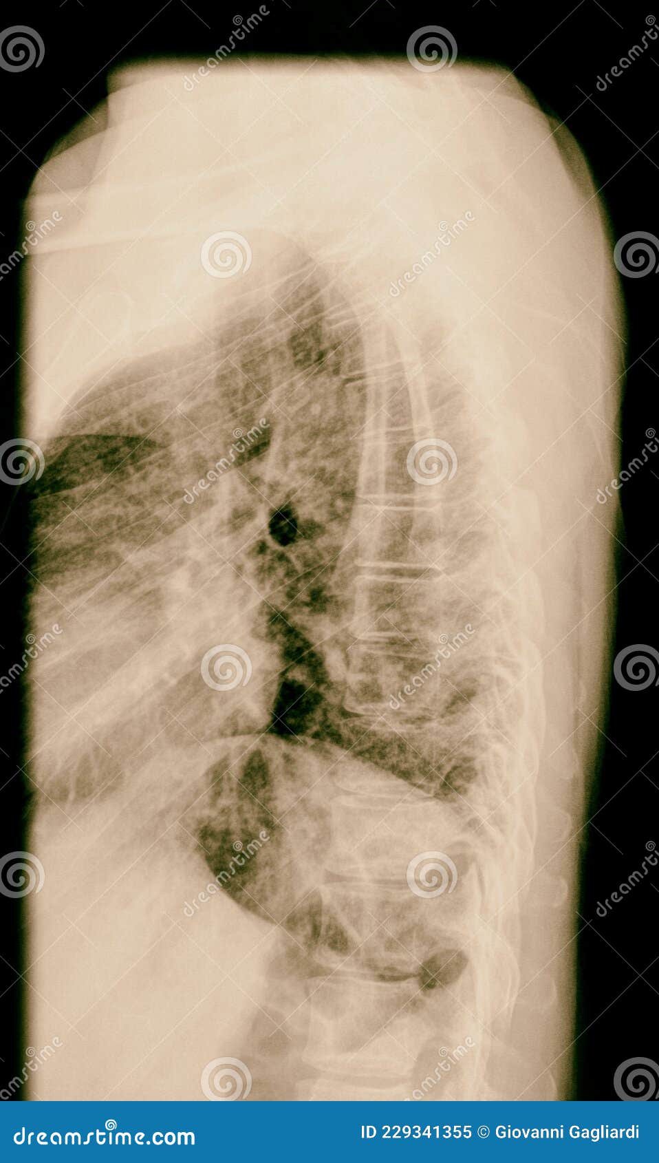 X-ray Lumbo-sacral Spine and Pelvis. Examination Scan Stock Image ...