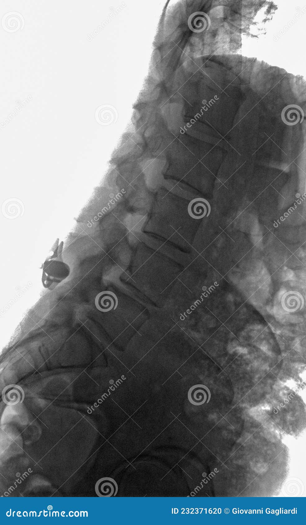 X-ray Lumbo-sacral Spine and Pelvis. Examination Scan Stock Photo ...