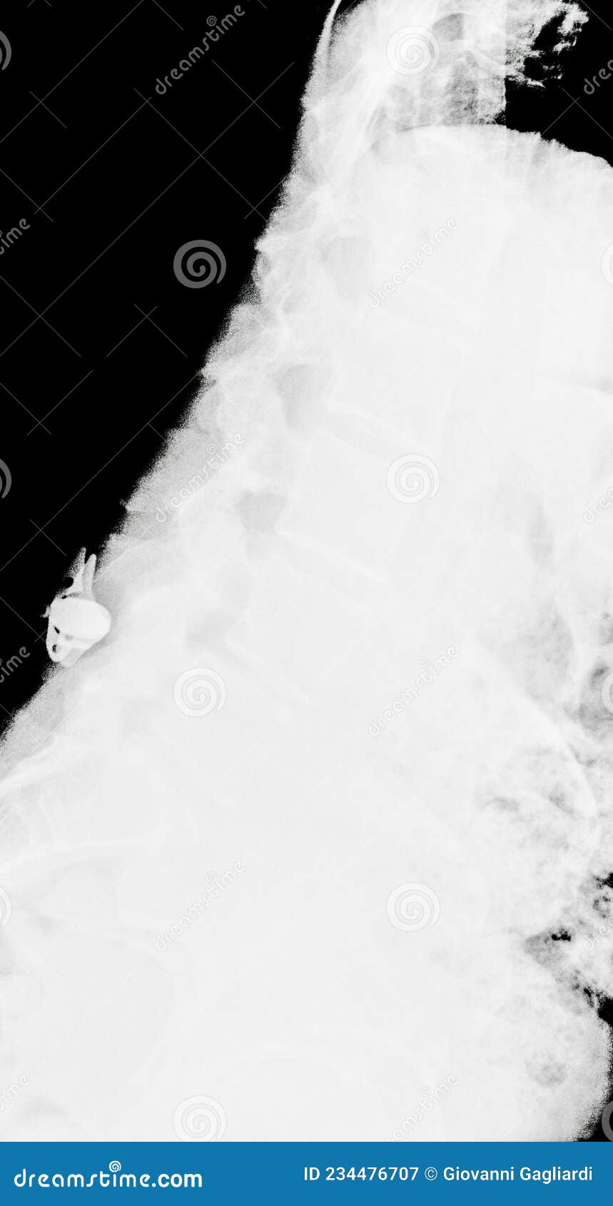 X-ray Lumbo-sacral Spine And Pelvis No Fracture, Dislocation , Bony ...