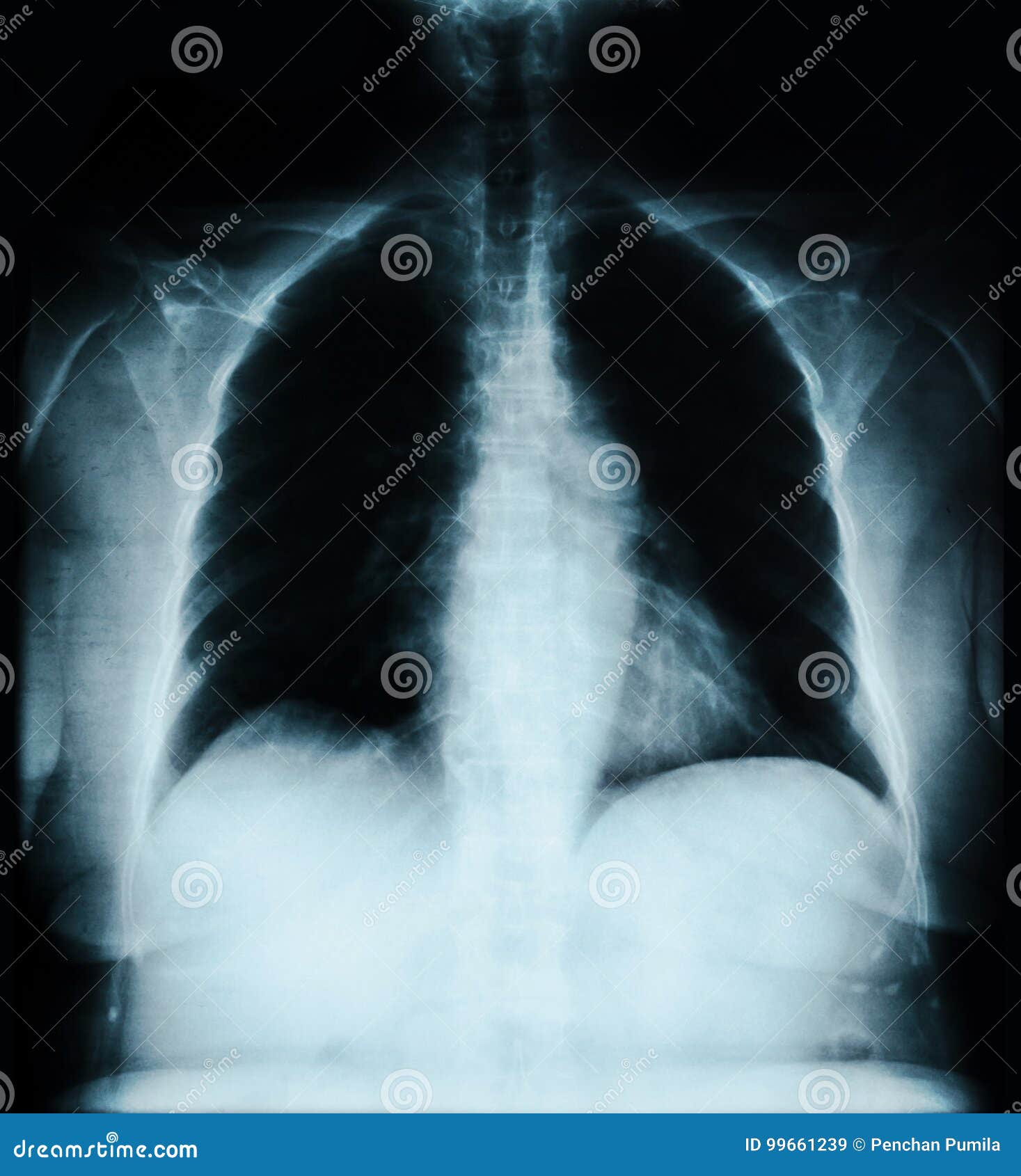 X-ray lung image. stock image. Image of lungs, mycobacterium - 99661239