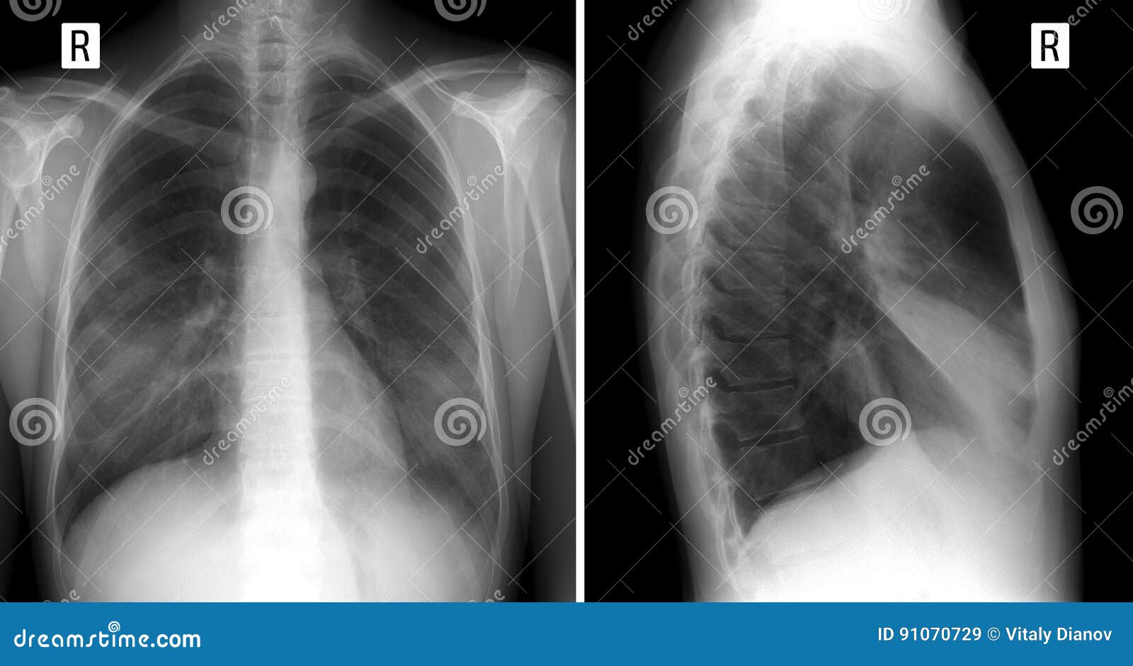 X Ray Lung Showing A Large Infiltrate In The Middle Lobe Of The Right Lung Pneumonia Front