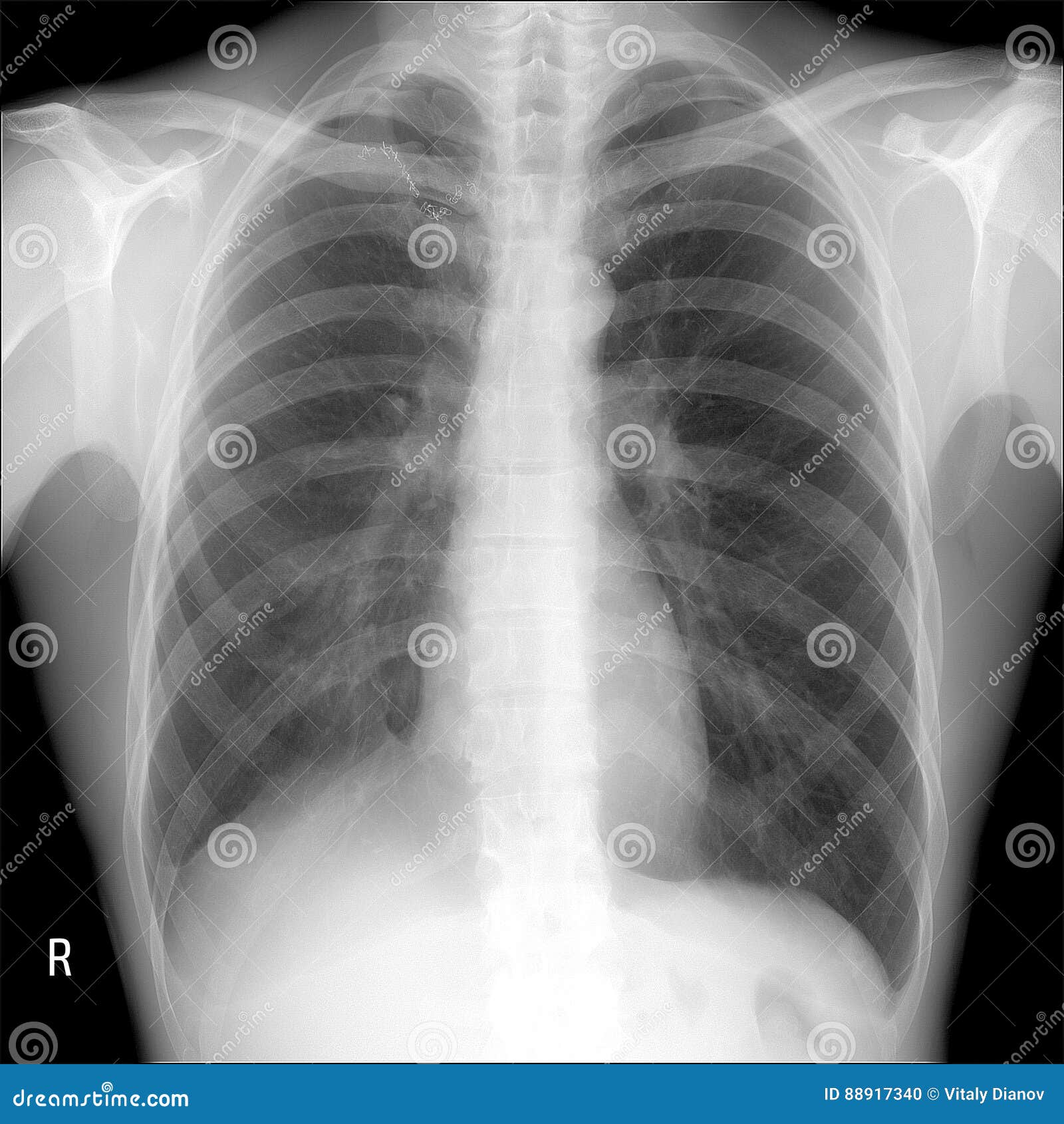 X-ray Lungs: Lobectomy Right Lung Post Tuberculosis Stock Photo - Image ...