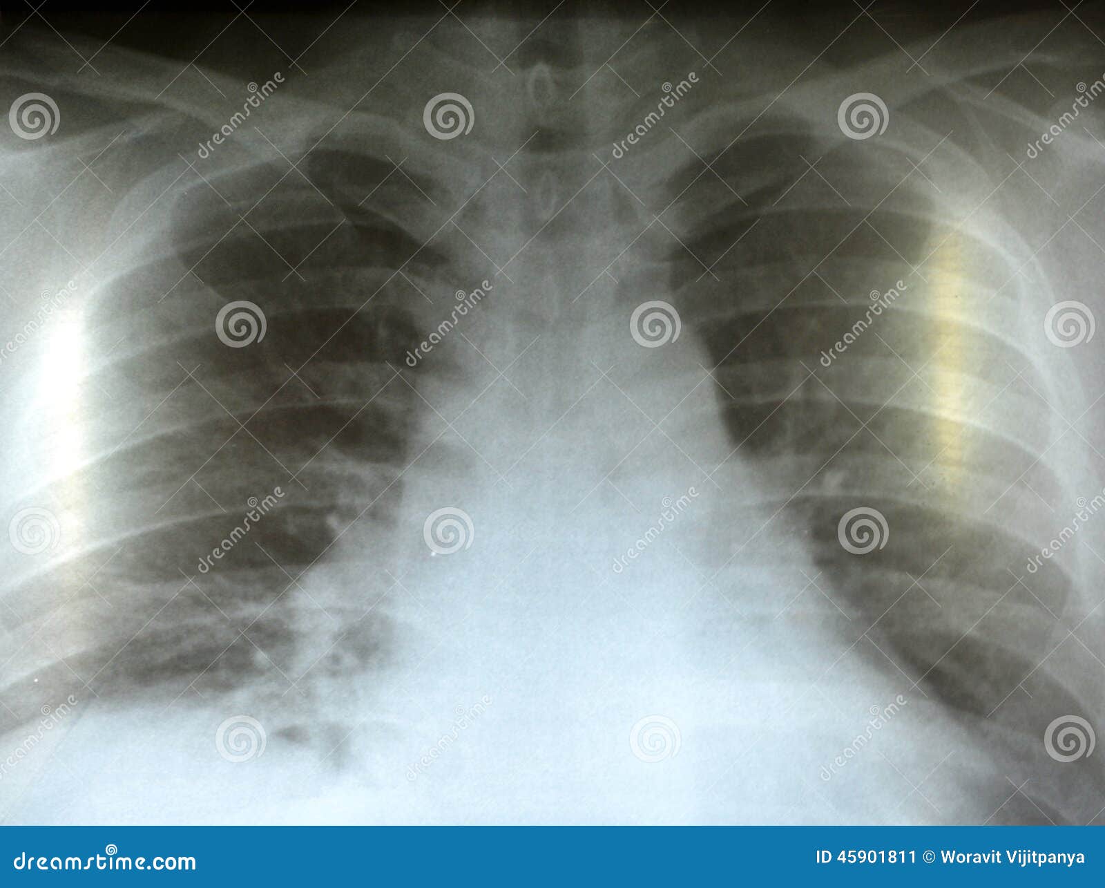 X-ray of lungs stock image. Image of clinic, check, diagnosis - 45901811