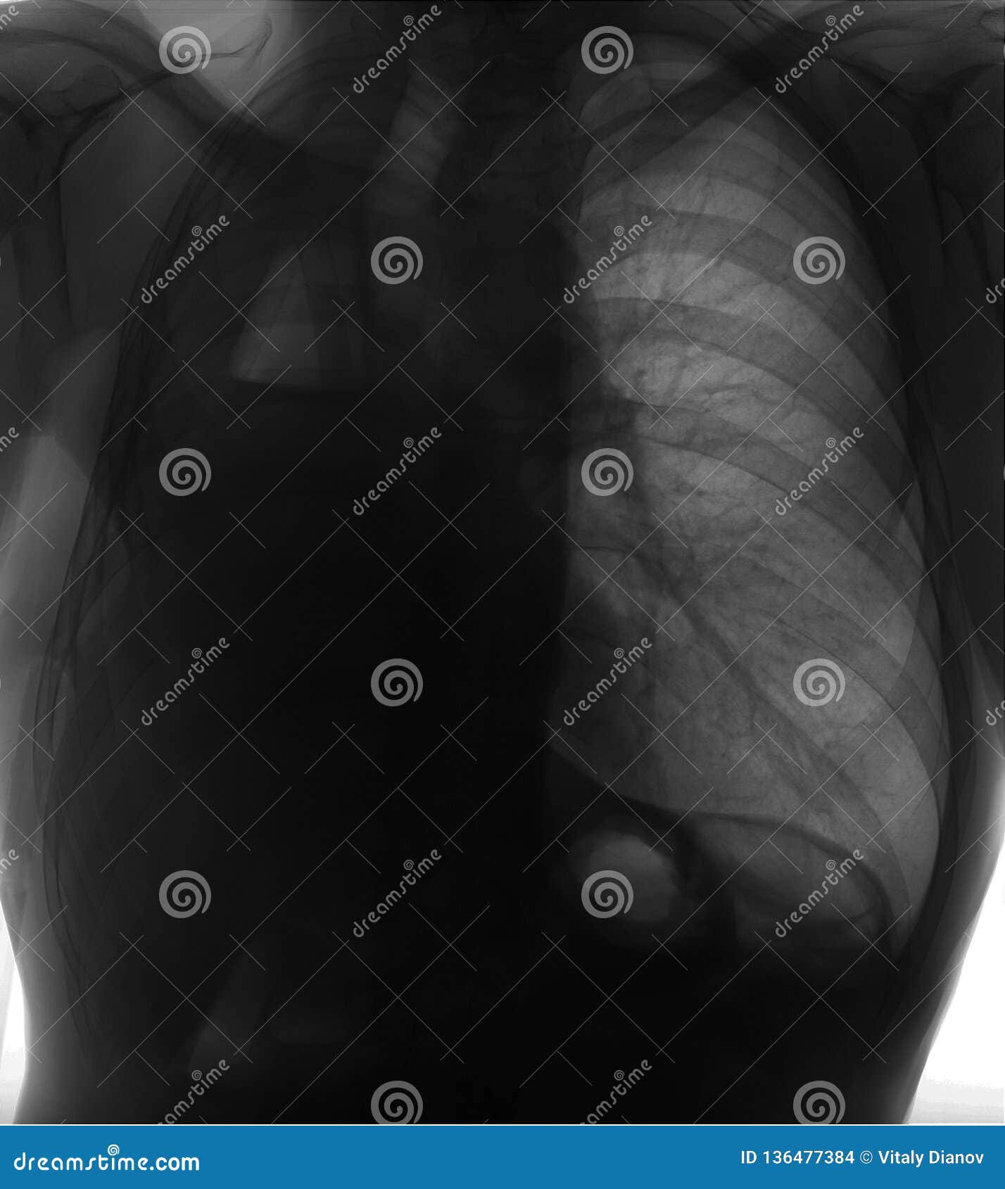 X-ray of the Lungs. Right-sided Pneumonectomy. Negative Stock Photo ...