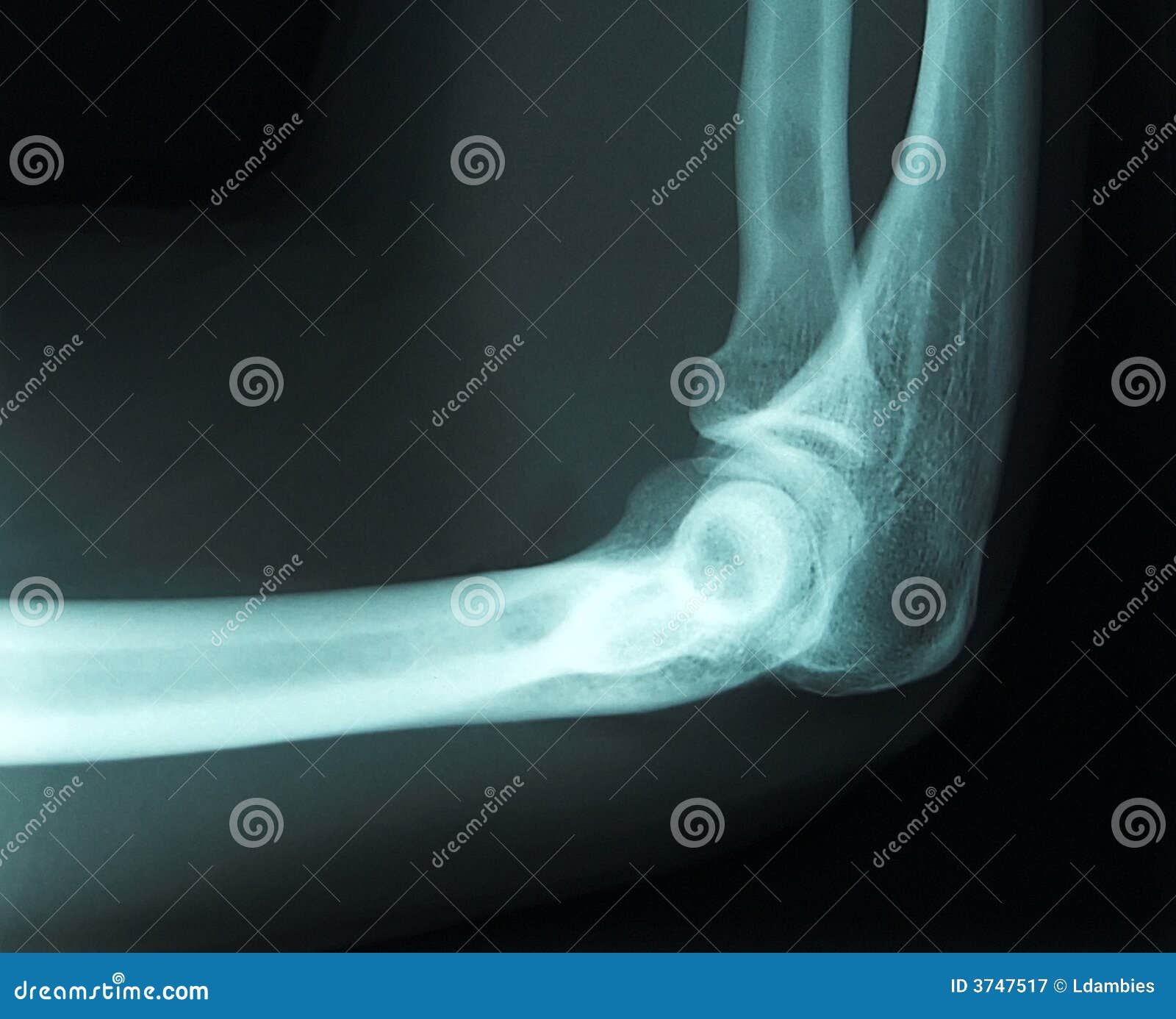 X-ray of a male arm stock image. Image of body, technology - 3747517