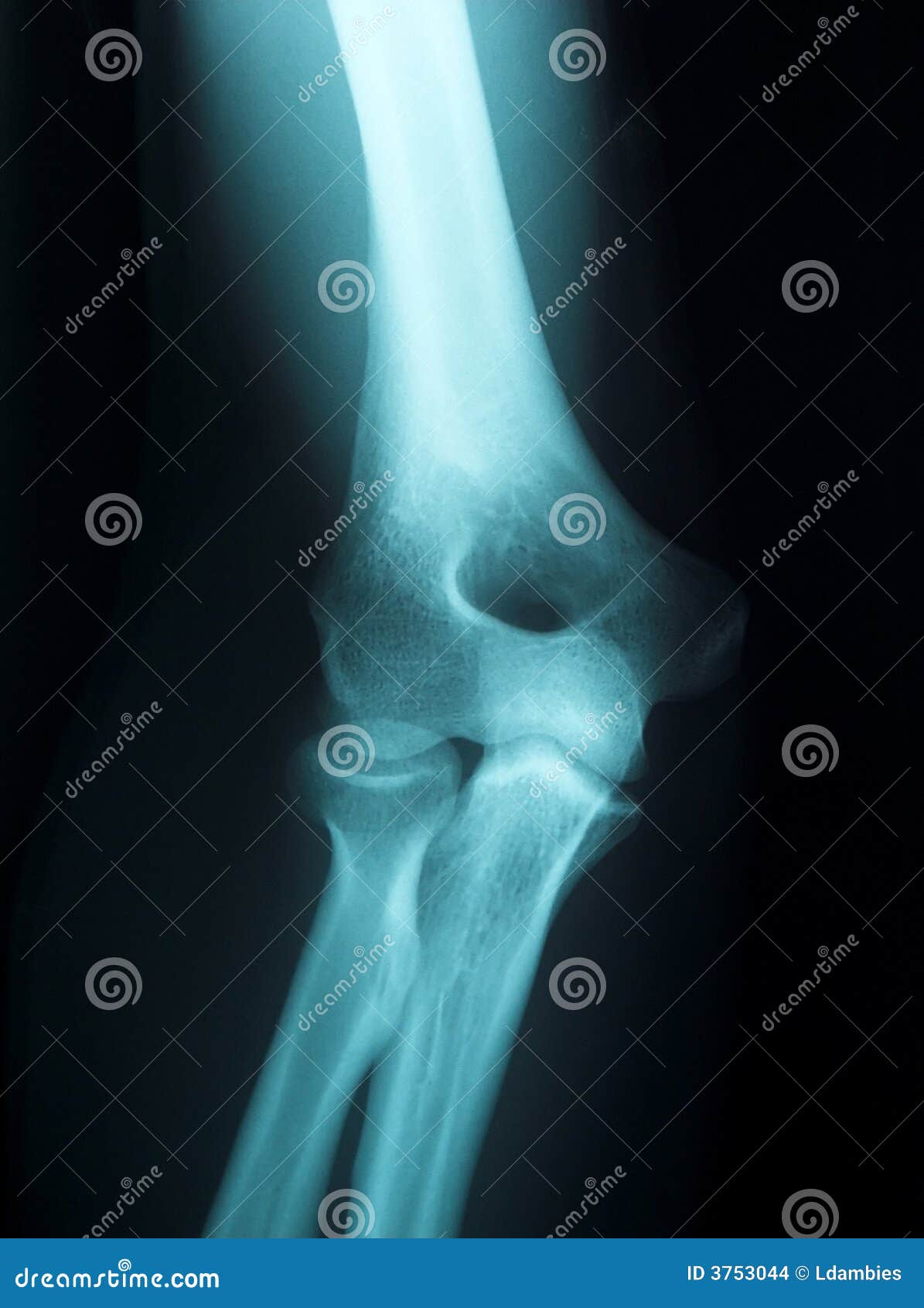 X-ray of a male arm stock photo. Image of screening, radiography - 3753044