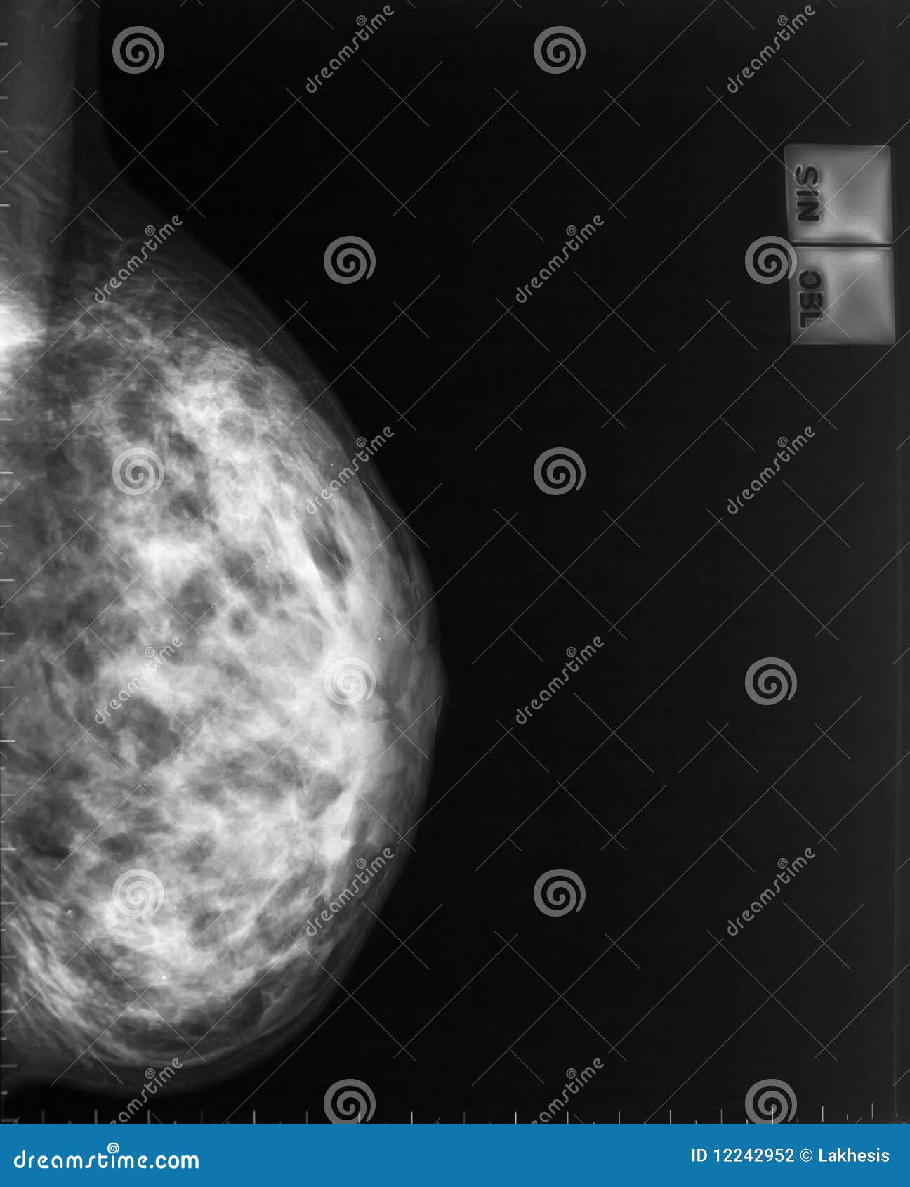 X-ray mammogram stock photo. Image of hospital, protection - 12242952