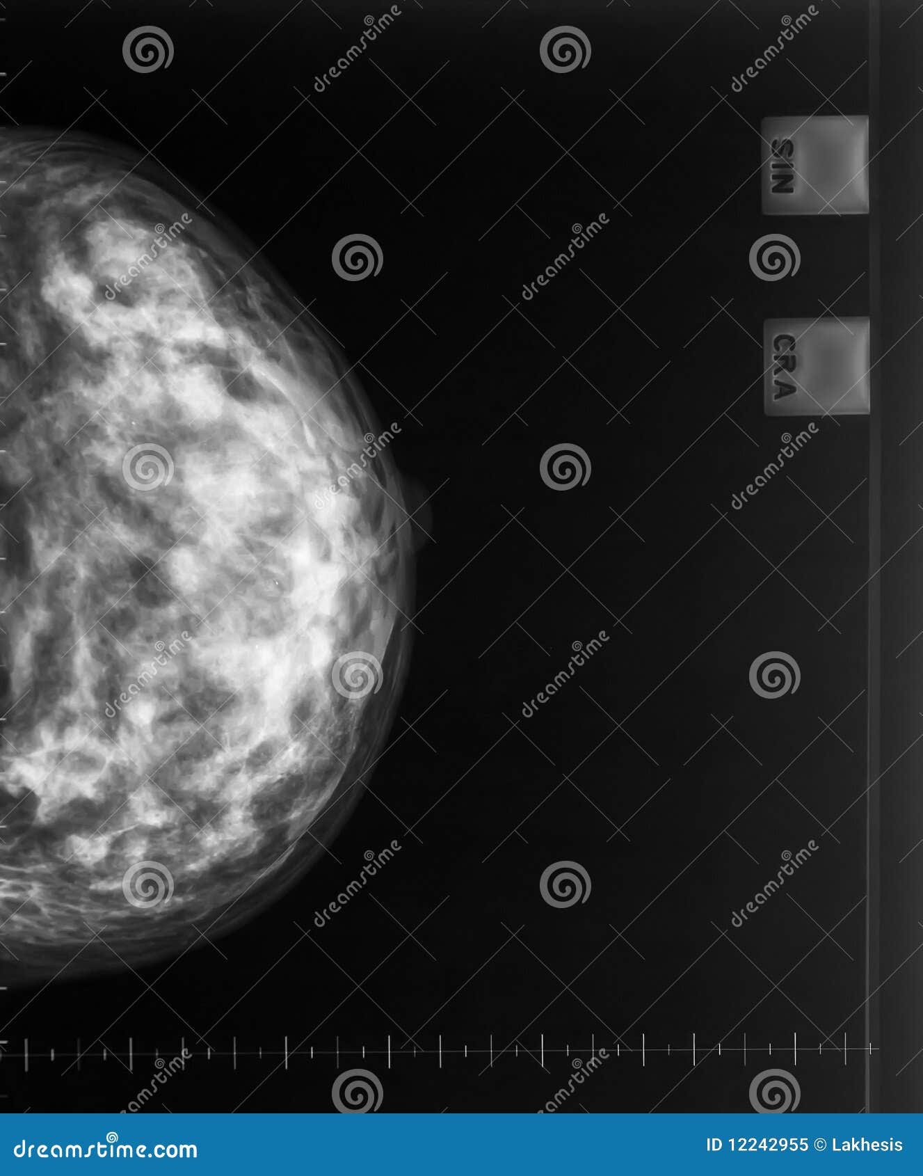 X-ray mammogram stock image. Image of medicine, prevent - 12242955