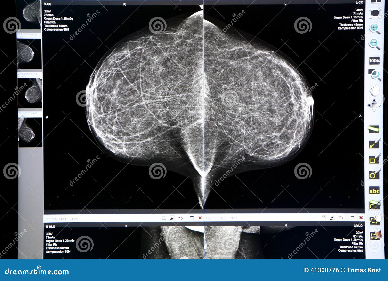 X-ray mammogram stock photo. Image of cancer, prevention - 41308776