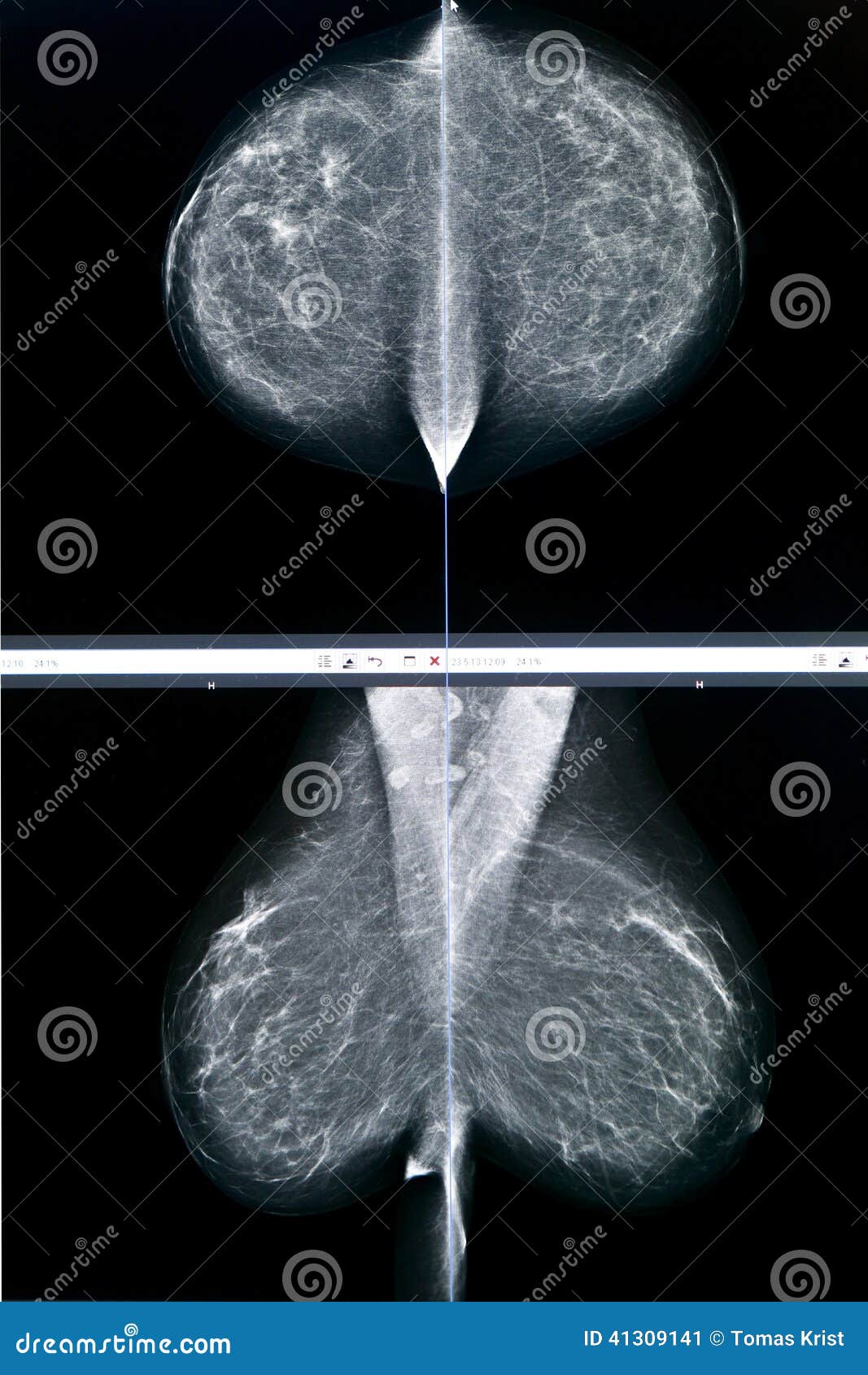 X-ray Mammogram Royalty-Free Stock Photography | CartoonDealer.com ...