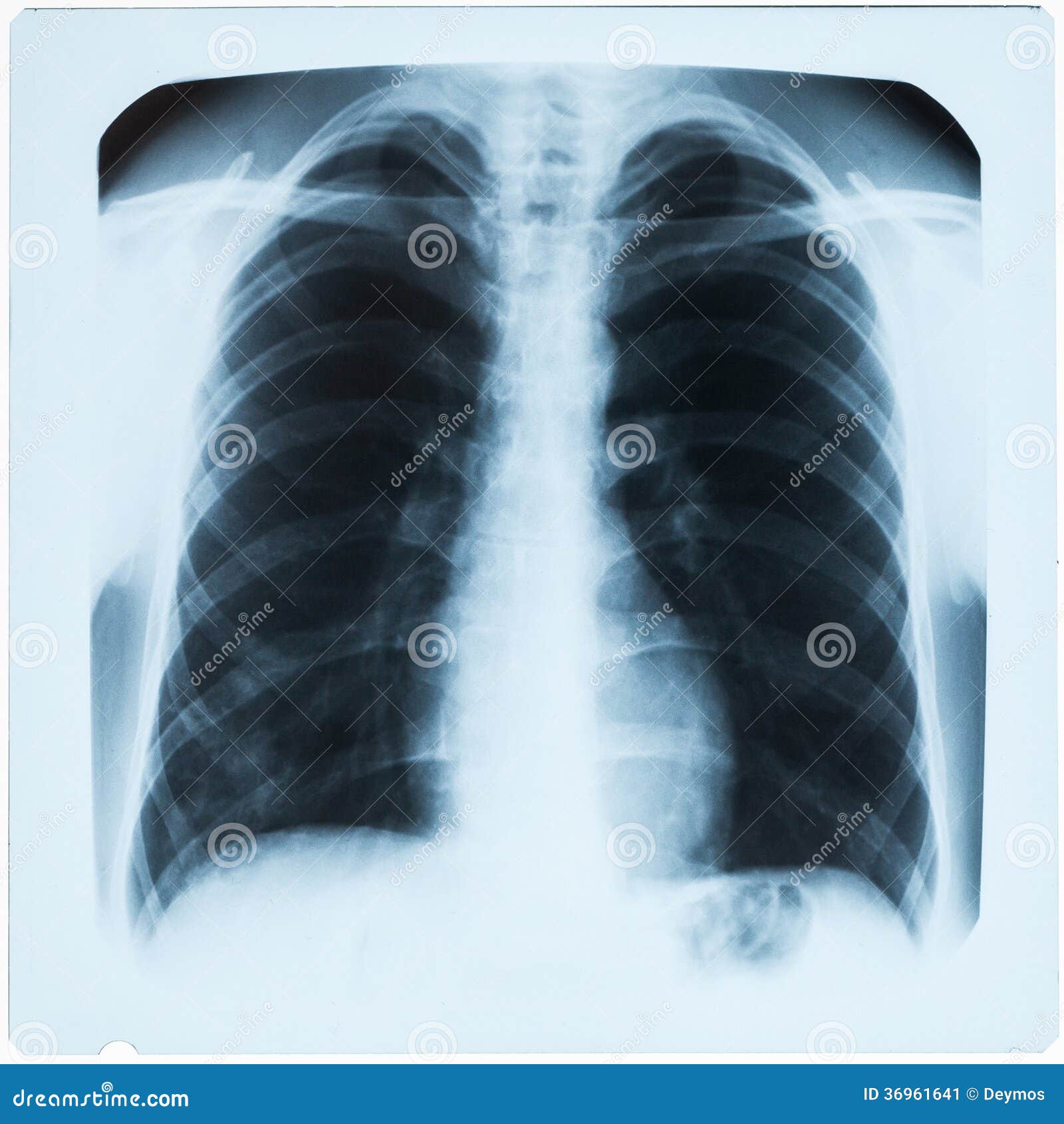 X-ray Of Man's Lungs During Pneumonia Stock Image - Image: 36961641