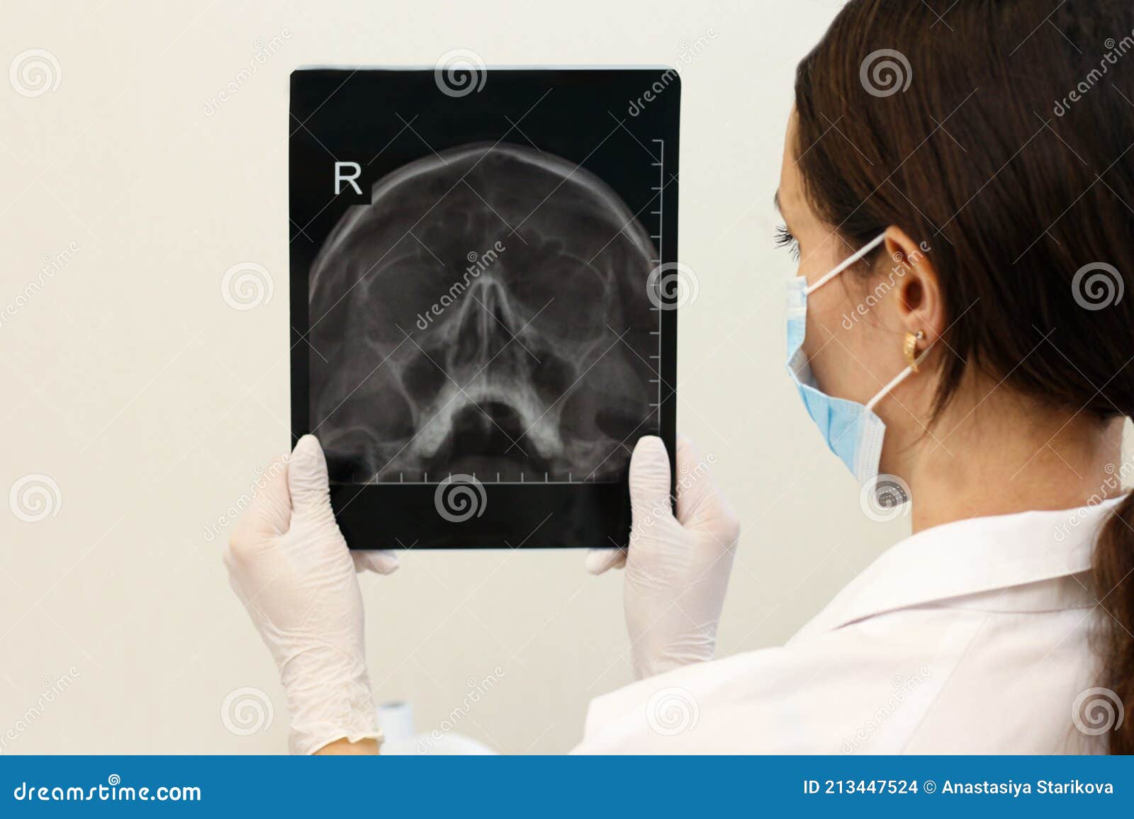 Sinusitis . Film X-ray Of Human Skull With Inflamed At Sinus Royalty ...