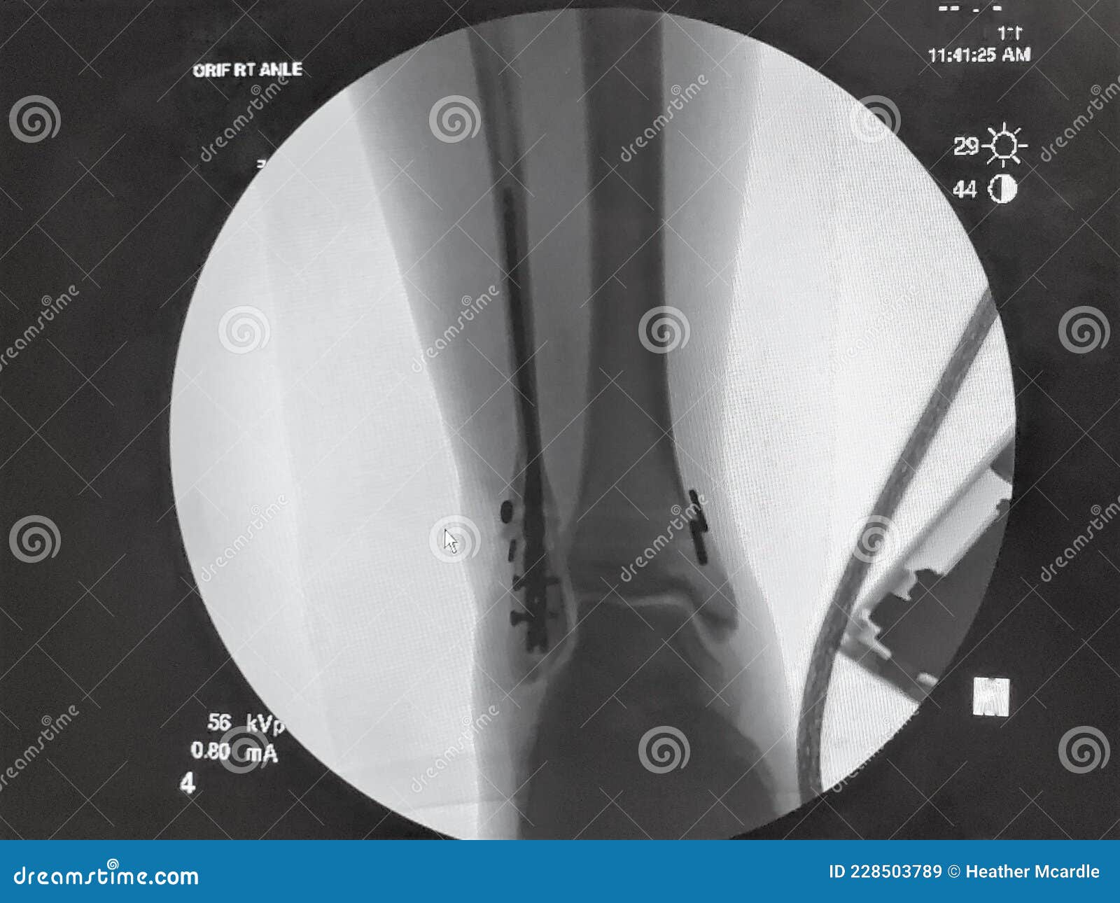 X-ray of Metal Implants through Broken Fibula Stock Image - Image of ...