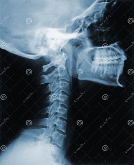X-Ray of the Neck stock photo. Image of spine, fracture - 2234474