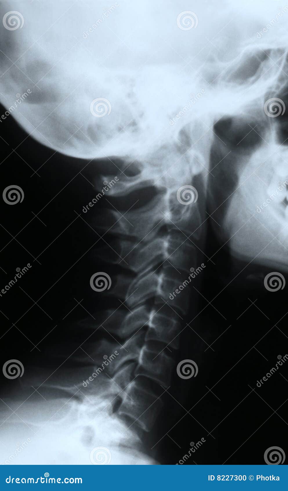 X ray of a neck stock photo. Image of link, hospital, vertebra - 8227300