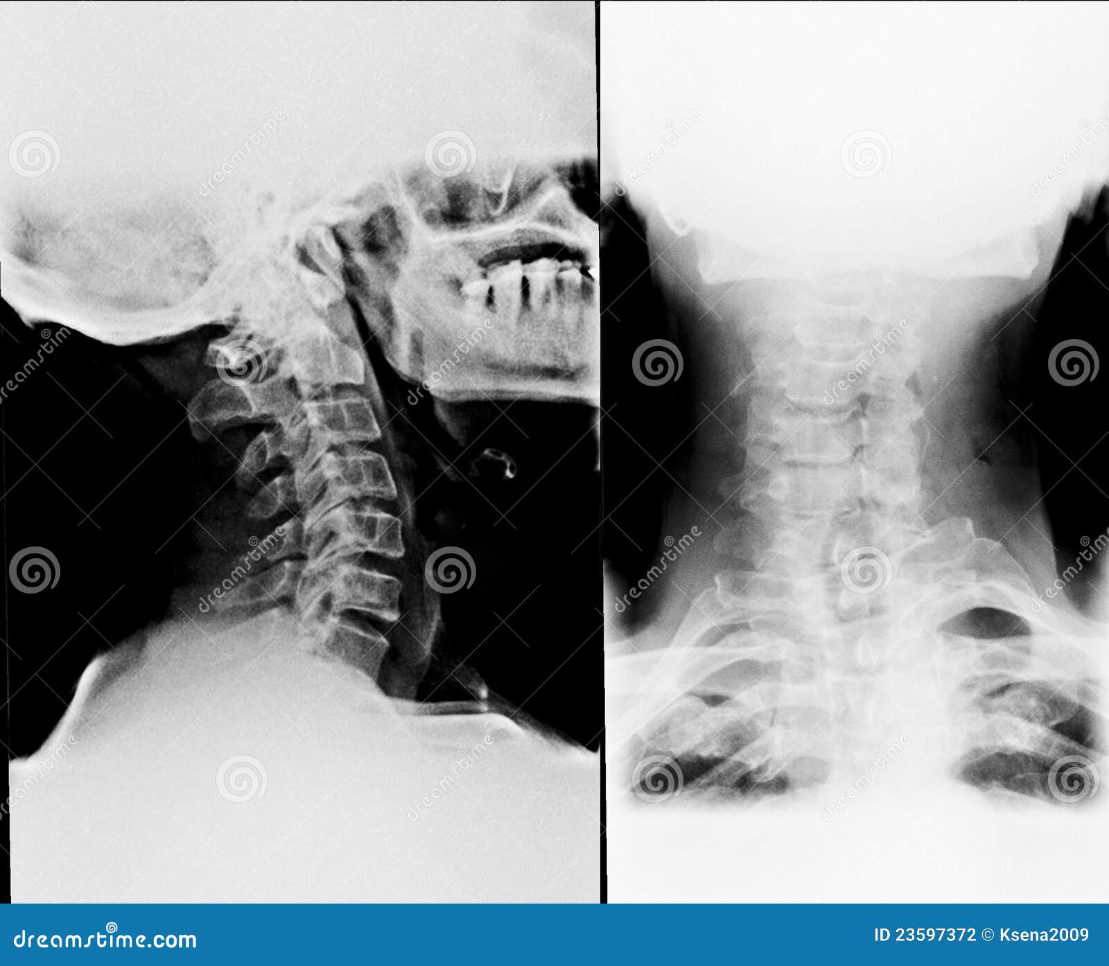 X-ray of the neck of human stock photo. Image of cavity - 23597372