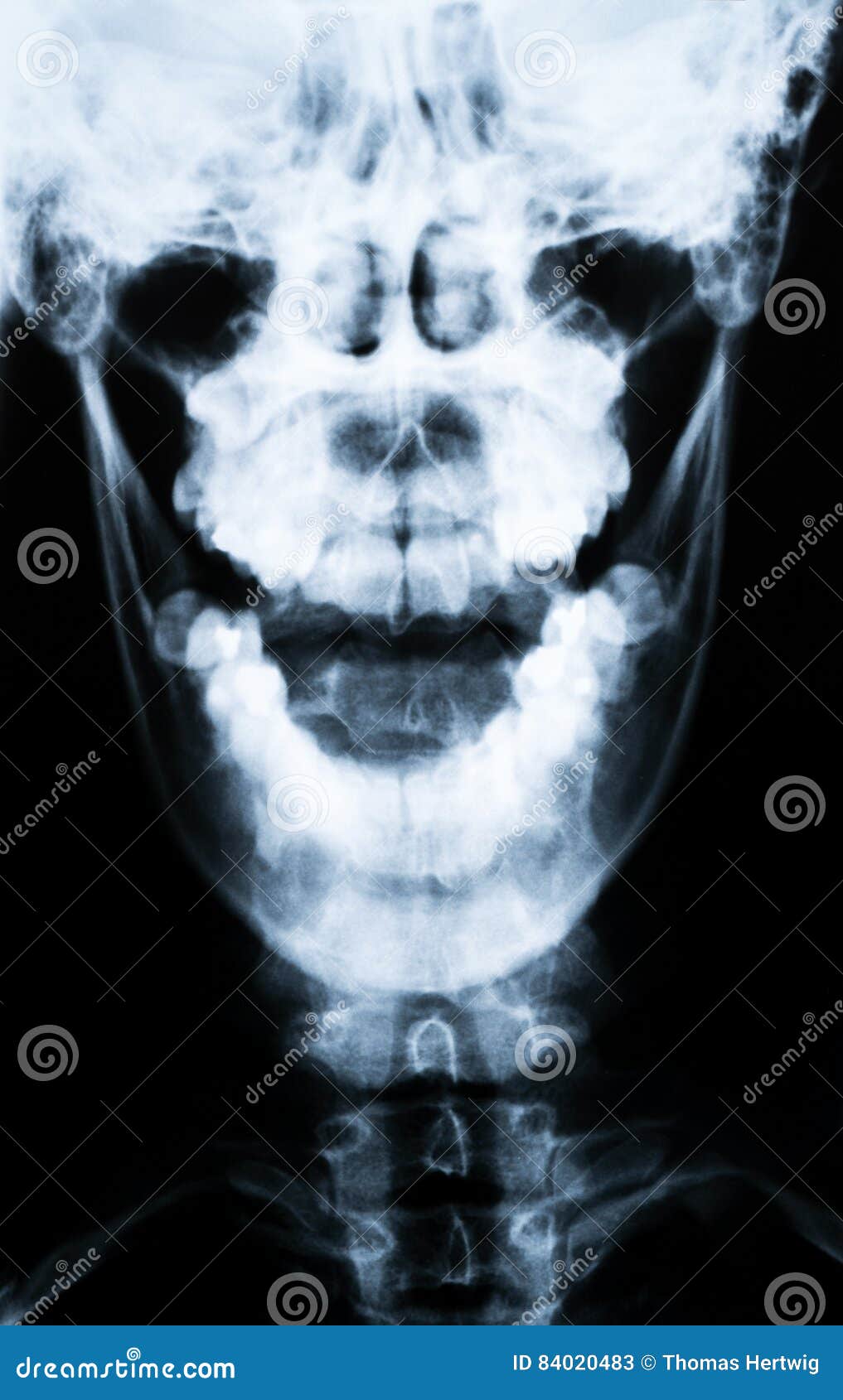 X-ray of the Neck and Skull - Front View Stock Image - Image of ...
