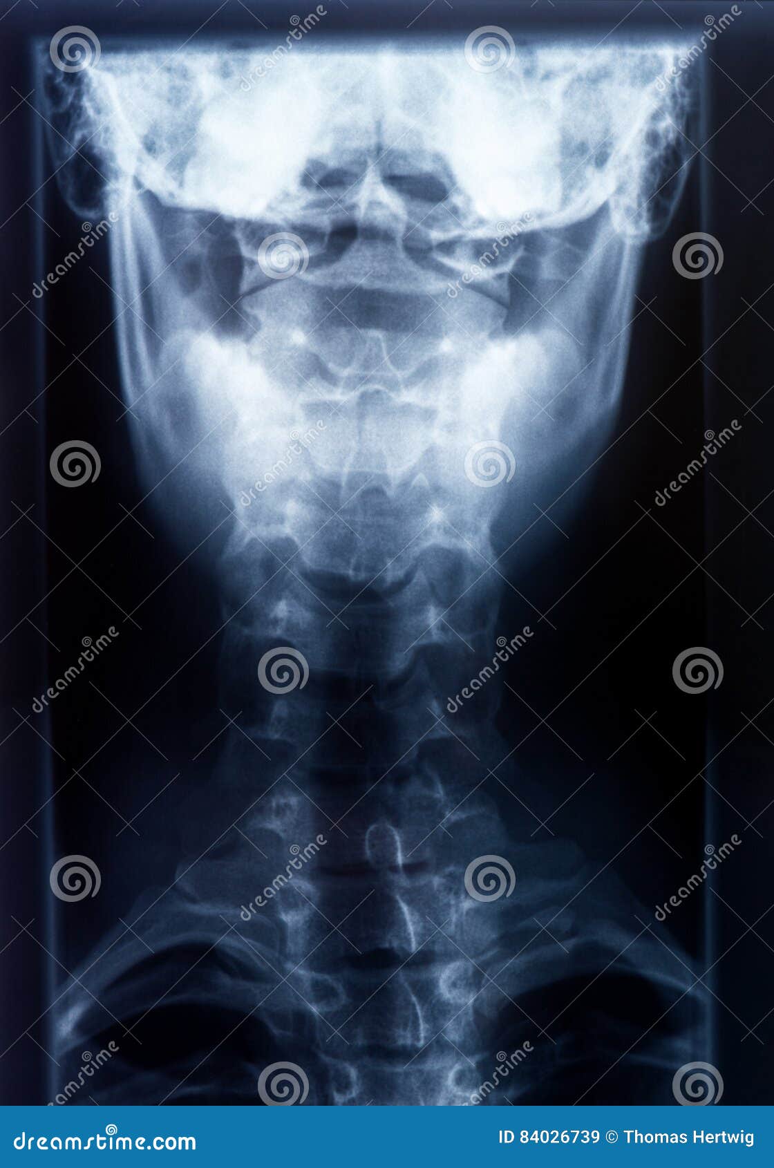 X-ray of the Neck and Skull - Rear View Stock Image - Image of medical ...