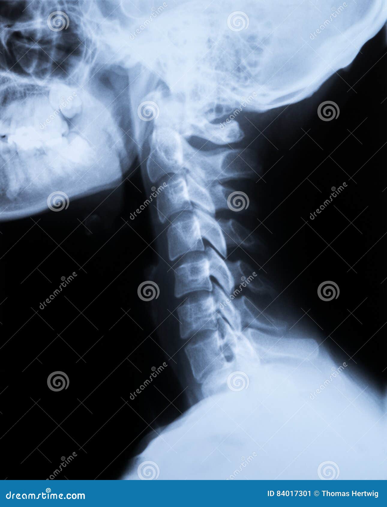 X-ray of the Neck and Skull - Side View Stock Image - Image of ...