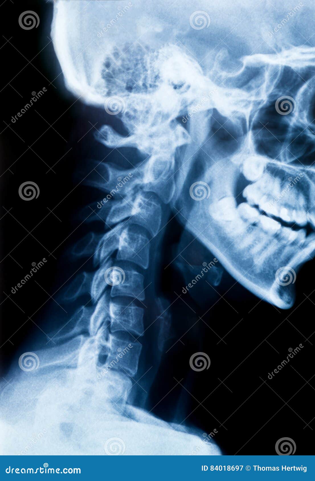 X-ray of the Neck and Skull - Side View Stock Image - Image of neck ...