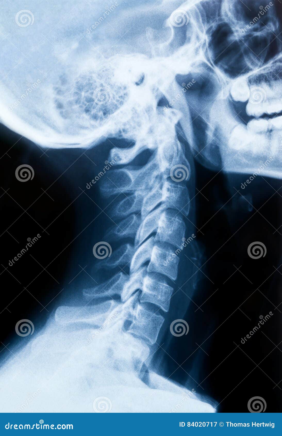 X-ray of the Neck and Skull - Side View Stock Image - Image of body ...