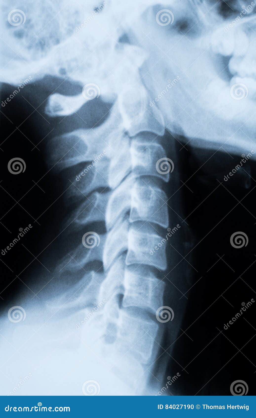 X-ray of the Neck and Skull - Side View Stock Photo - Image of hospital ...