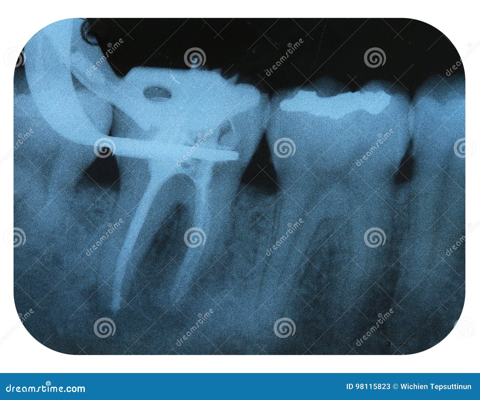 X-Ray Negative Tooth Filling Amalgam Royalty-Free Stock Photography ...