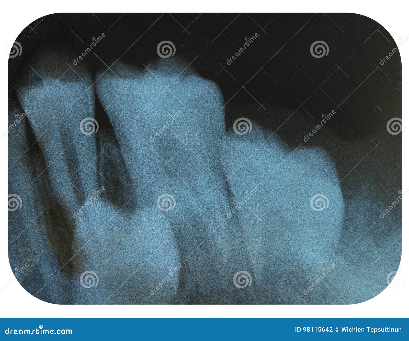 X-Ray Negative Tooth Impaction Stock Photo - Image of negative, dentine ...