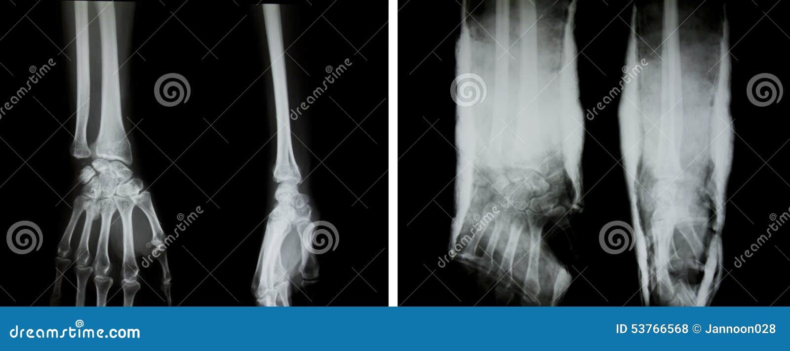 X-ray (normal Arms And Arms With Splint). Royalty-Free Stock Image ...