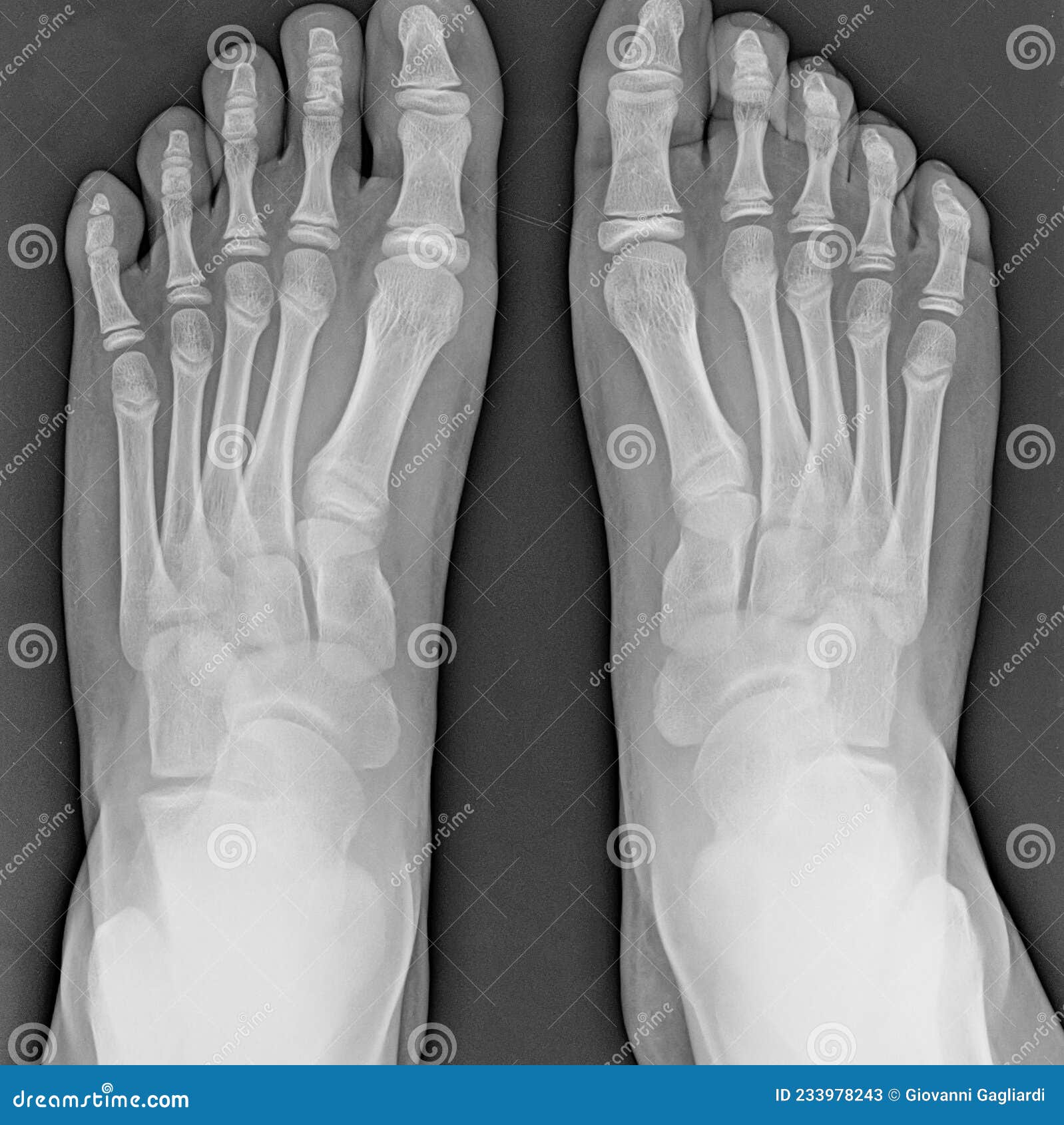 X-ray of Normal Human Feet. Top View Stock Image - Image of black ...