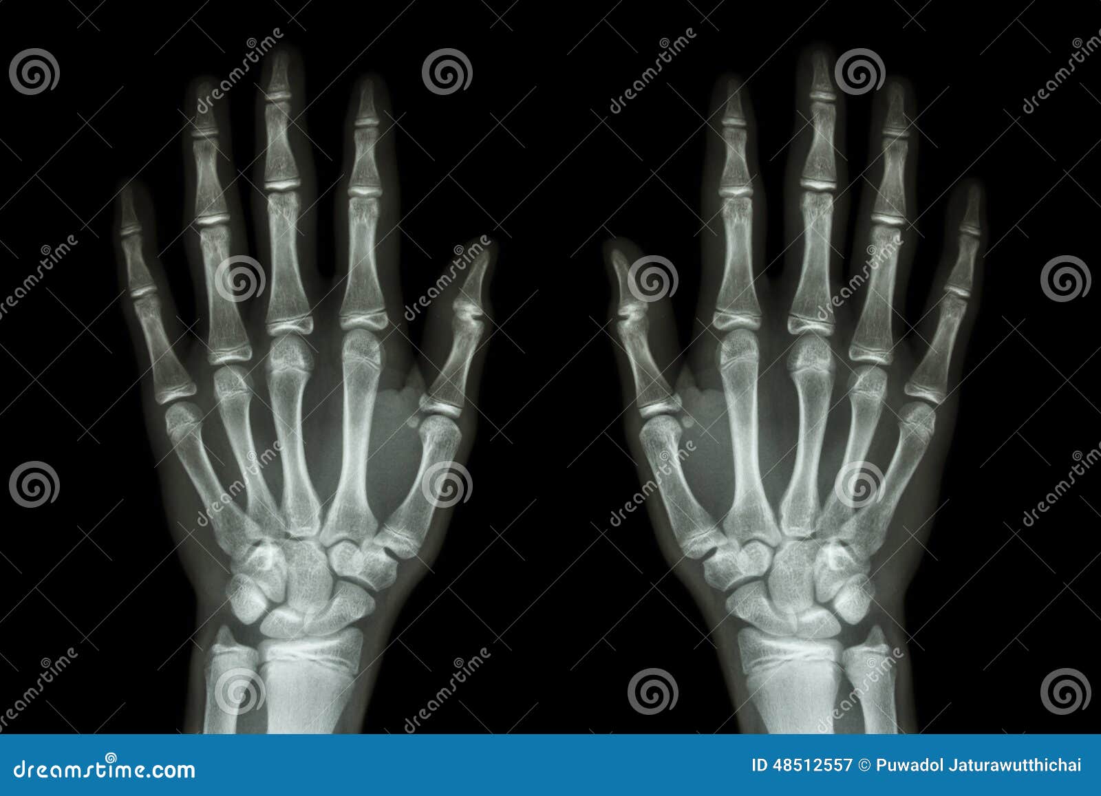 X-ray Normal Human Hands (front) Stock Image - Image of finger, pair ...