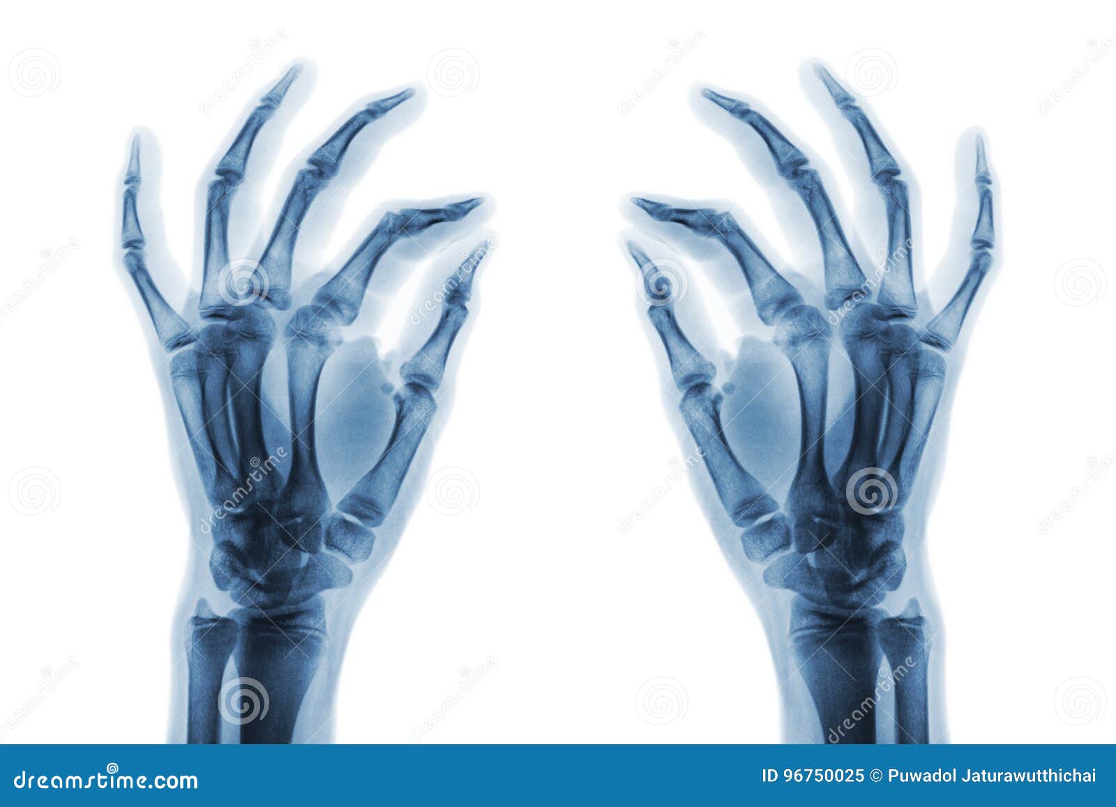 X-ray Normal Human Hands On White Background . Oblique View Stock Image ...