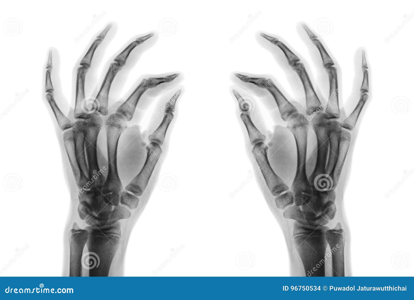 Normal Hand X Ray Human