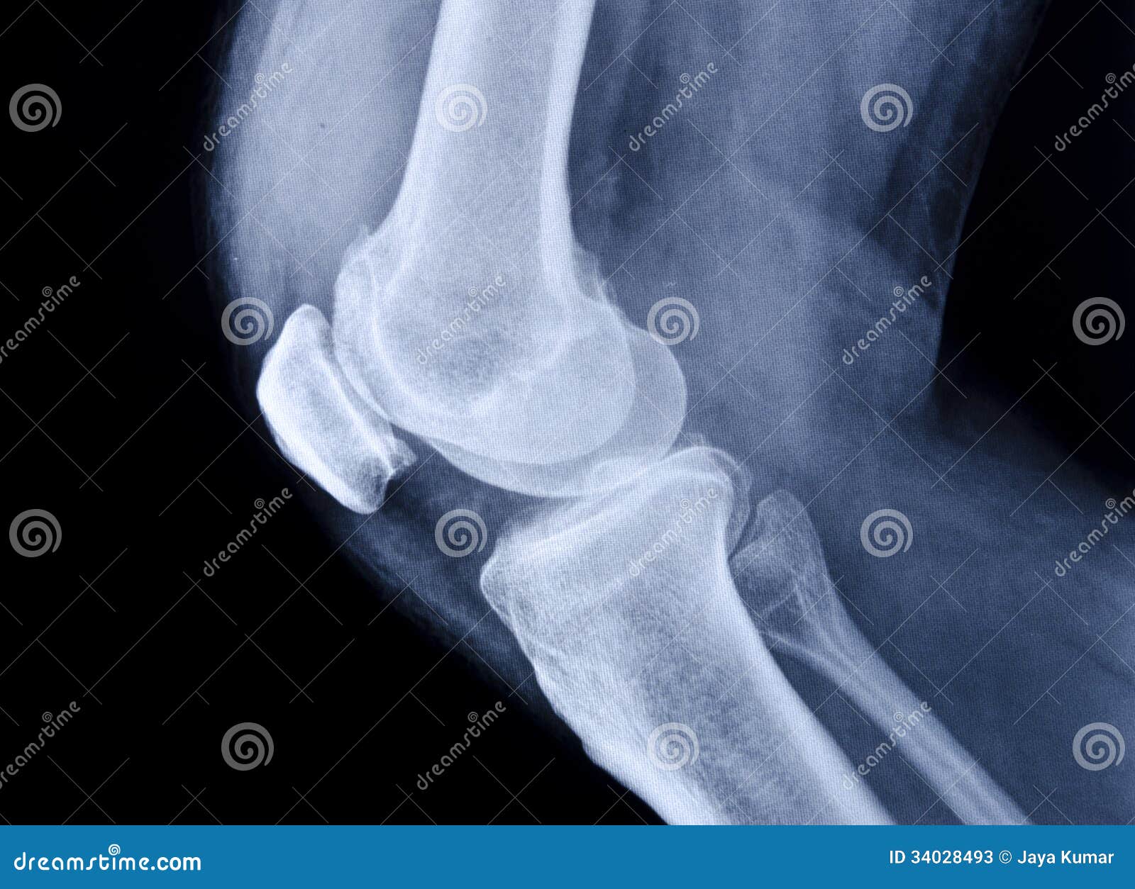 X-ray normal knee stock image. Image of backbone, neck - 34028493