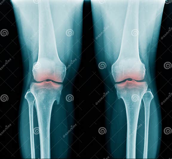 X-ray OA knee stock image. Image of osteoarthritis, healthcare - 123039625