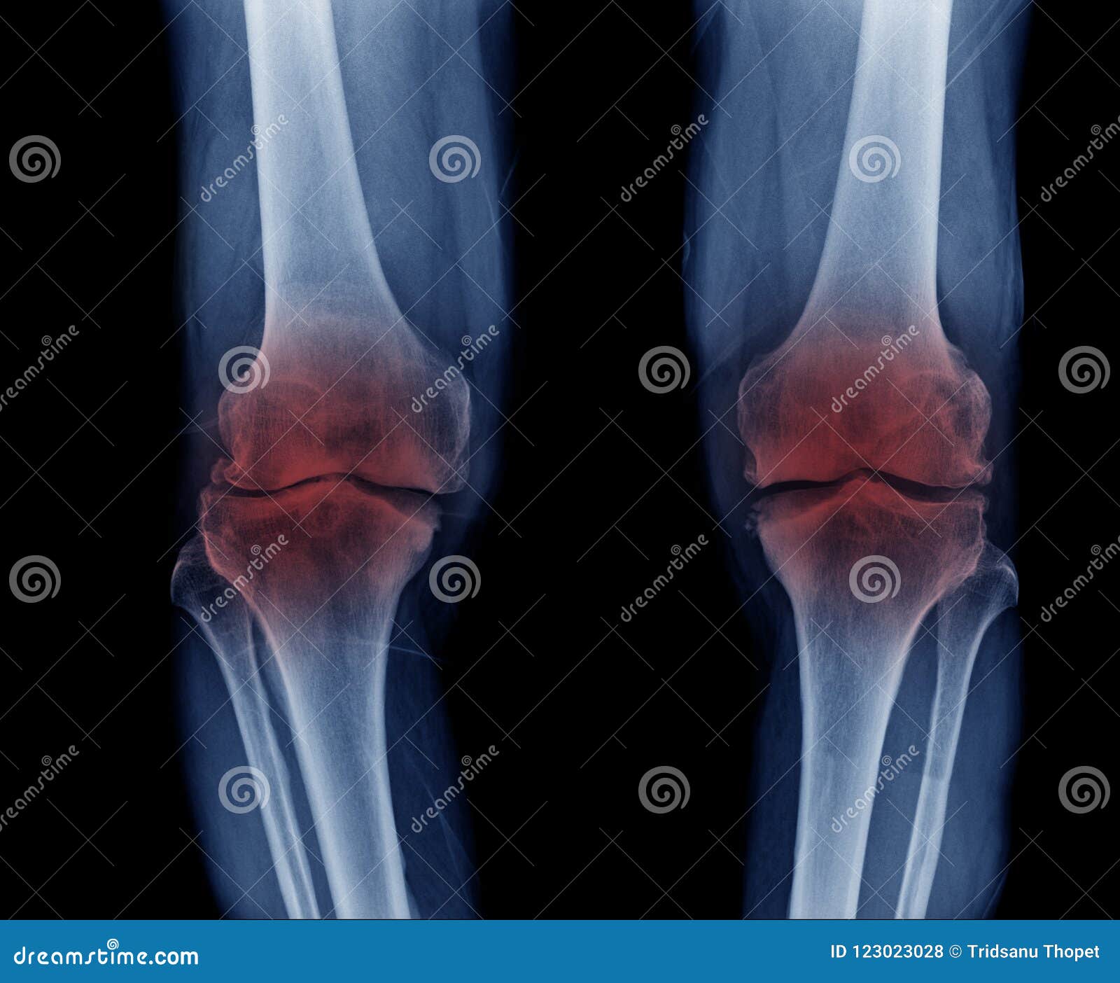 OA knee x-ray stock photo. Image of care, anatomy, joint - 123023028