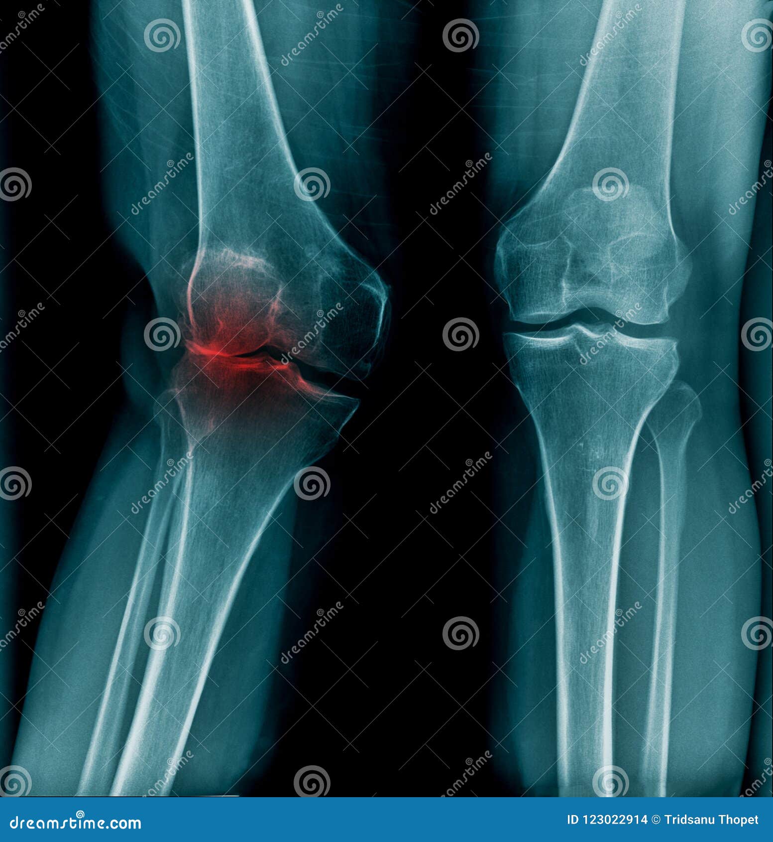 Genu valgus knee stock photo. Image of disease, black - 123022914