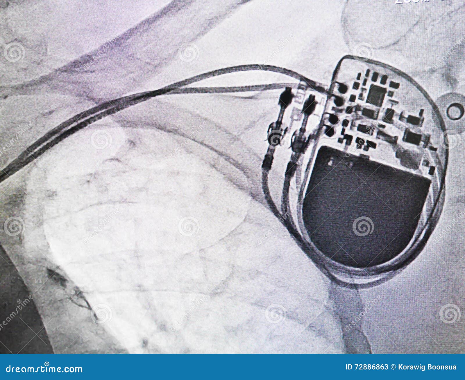 X-ray pacemaker stock image. Image of medical, pace, body - 72886863