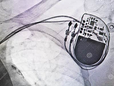 X-ray pacemaker stock image. Image of medical, pace, body - 72886863