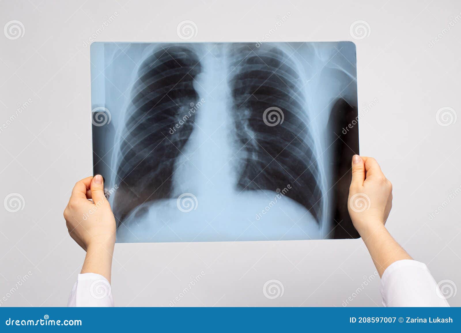 X-ray of a Patient with Pneumonia or Tuberculosis. Lung X-rays Stock ...