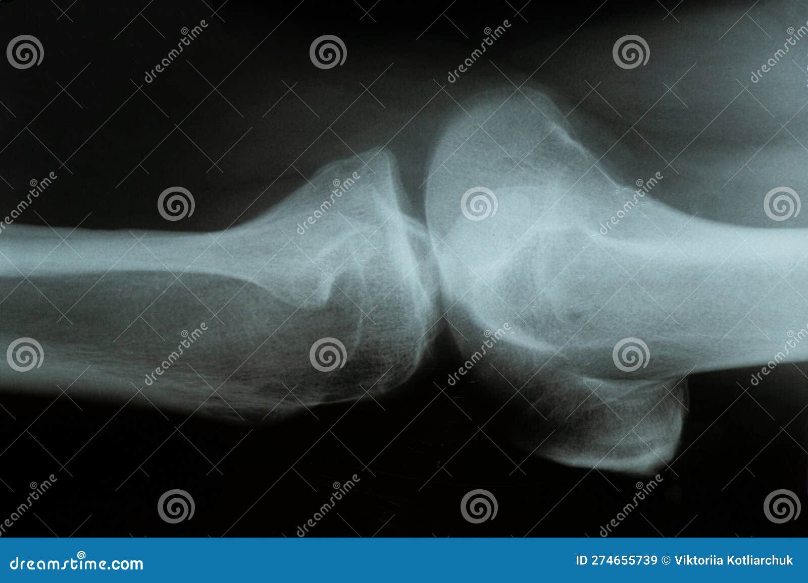 X-ray of a Patient with a Torn Meniscus of the Knee Joint in a Man and ...
